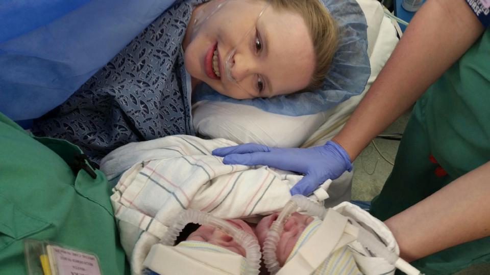 Conjoined twins die one day after delivery: \'Even through this ...